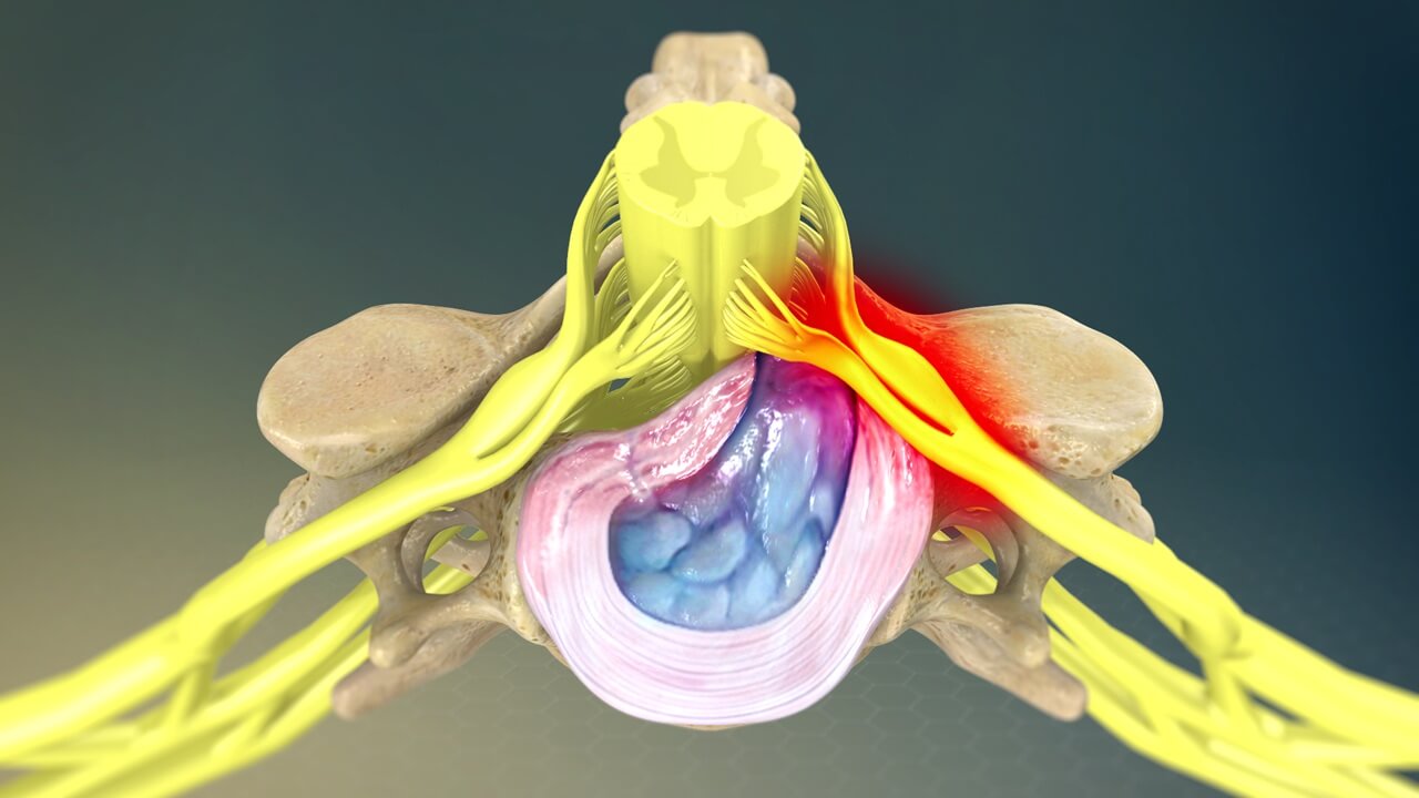 Cervical Decompression for Herniated Discs in Naperville IL - Synergy ...