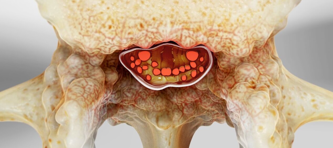 Cervical Decompression for Cervical Stenosis in Naperville IL - Synergy ...